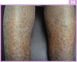 ICHTHYOSIS X-LINKED – Pertubuhan Kebajikan Pengidap Ichthyosis Wilayah ...